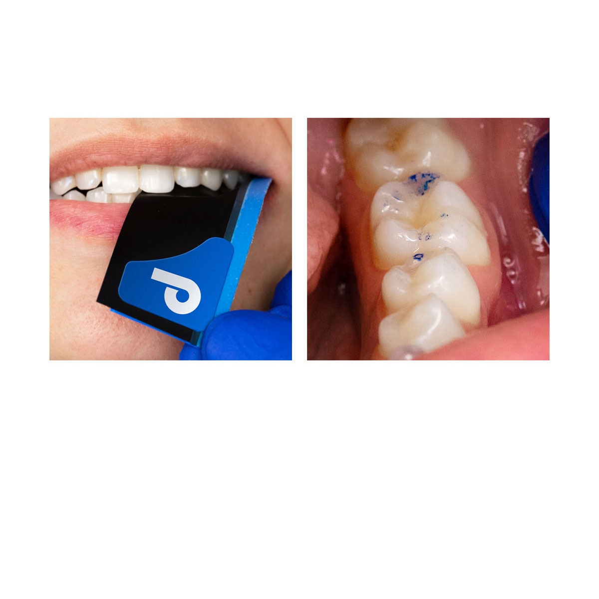 AccuFilm® FastCheck Pre-Mounted Articulating Film